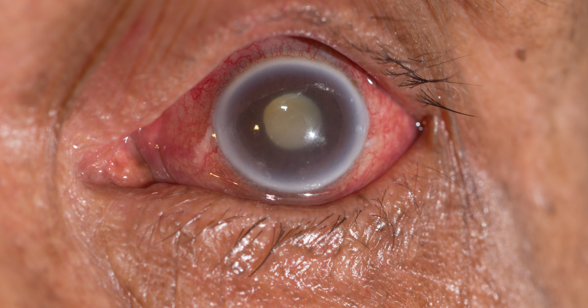 Understanding Angle-Closure Glaucoma