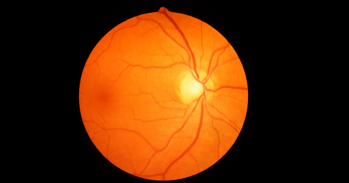 The Optic Disc and Its Role in Glaucoma